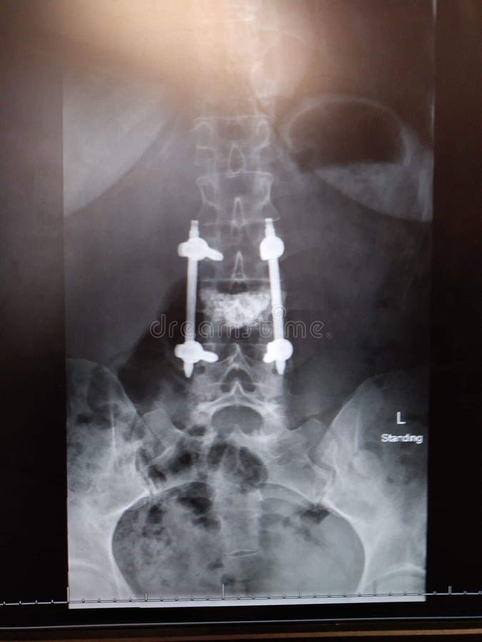 Titanium stock photo. Image of back, rods, exray, xraypain - 159976094