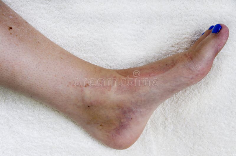 Tobillo roto radiografía imagen de archivo. Imagen de doloroso - 7108445