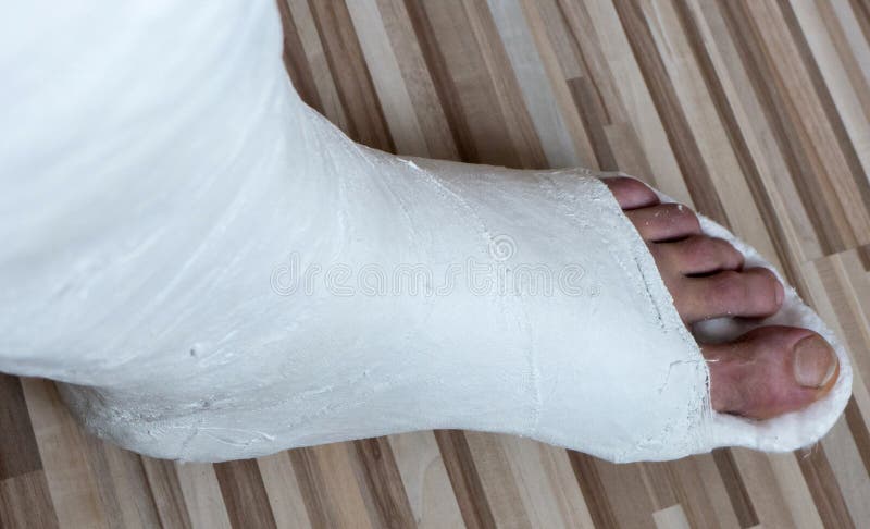 Tobillo quebrado en yeso foto de archivo. Imagen de hueso - 65568598