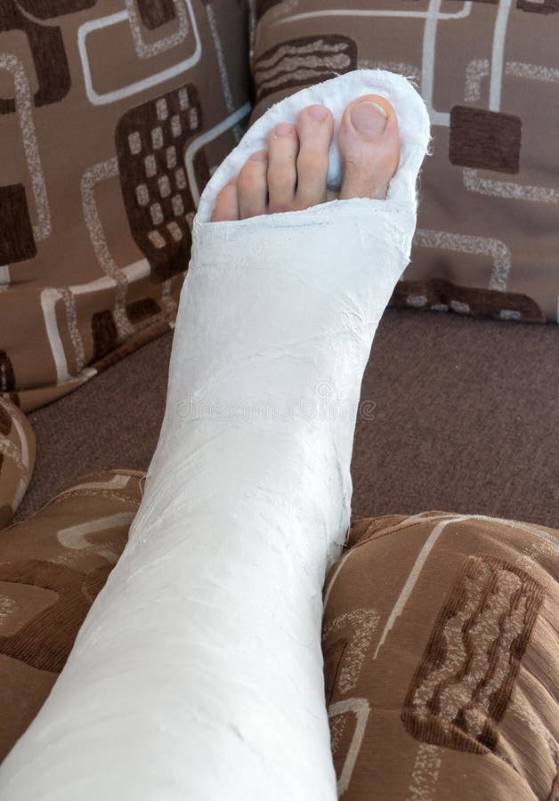 Tobillo quebrado en yeso imagen de archivo. Imagen de accidente - 65568599