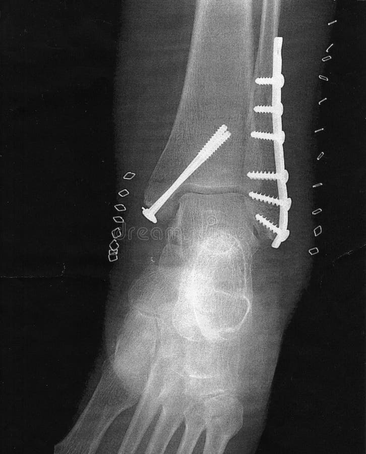 Radiografía De Tobillo Fracturado Imagen de archivo - Imagen de ...