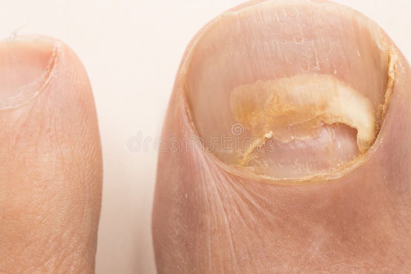 Toe Nail Fungus on a Big Toe Stock Image - Image of pedicure, peel ...