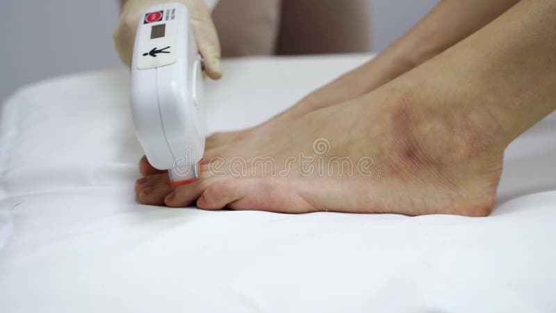 Toe Procedure. a Professional Dermatologist Uses Modern Technology ...