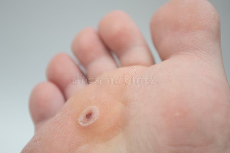 Toe Wart. Foot with Wart on a Toe Stock Photo - Image of dermatology ...