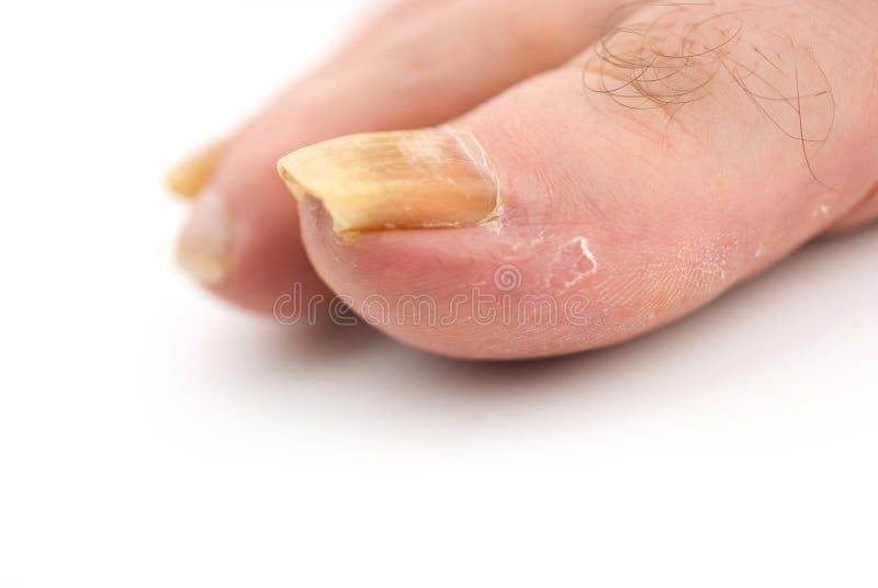 Toenail Fungus stock photo. Image of foot, disgust, toenail - 17905028
