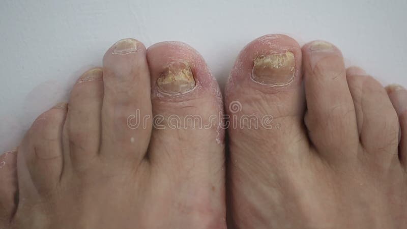 Toenail with Fungal Infection or Damage, Close Up of Nail Health ...