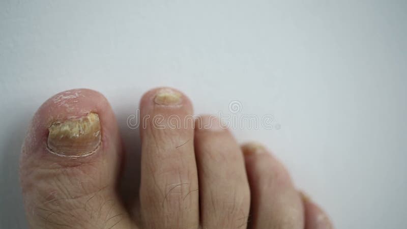 Toenail with Fungal Infection or Damage, Close Up of Nail Health ...
