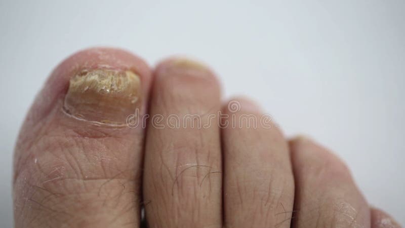 Toenail with Fungal Infection or Damage, Close Up of Nail Health ...