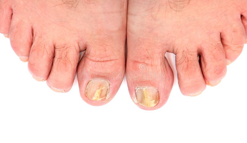 Unhealthy Toenails