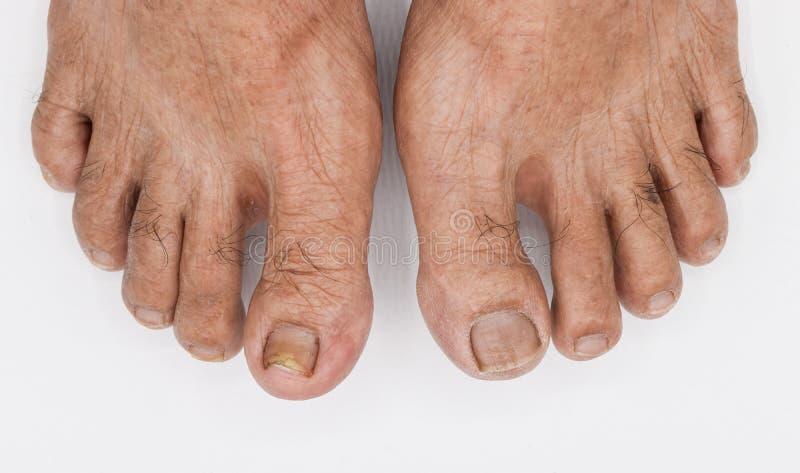 Toes of Asian Elder Man. Concept of Aging Stock Photo - Image of fungus ...