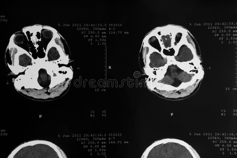 Tomogram MRI van hersenen stock afbeelding. Image of kanker - 20328419