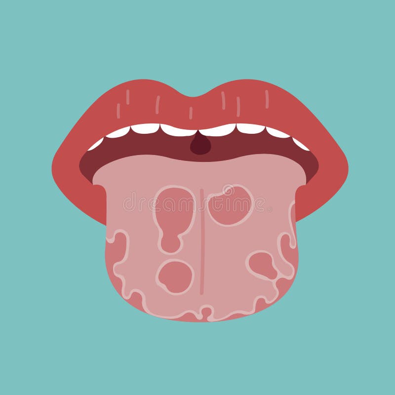 Tongue Disease, Vector of Organ Concept Stock Vector - Illustration of ...