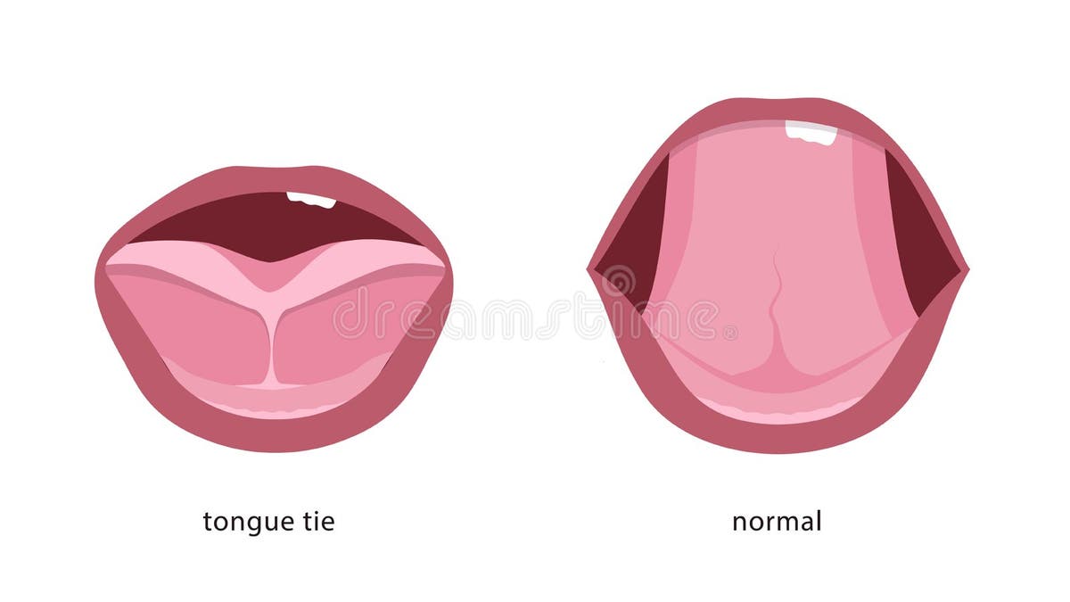 Lingual Frenulum Stock Illustrations 3 Lingual Frenulum Stock