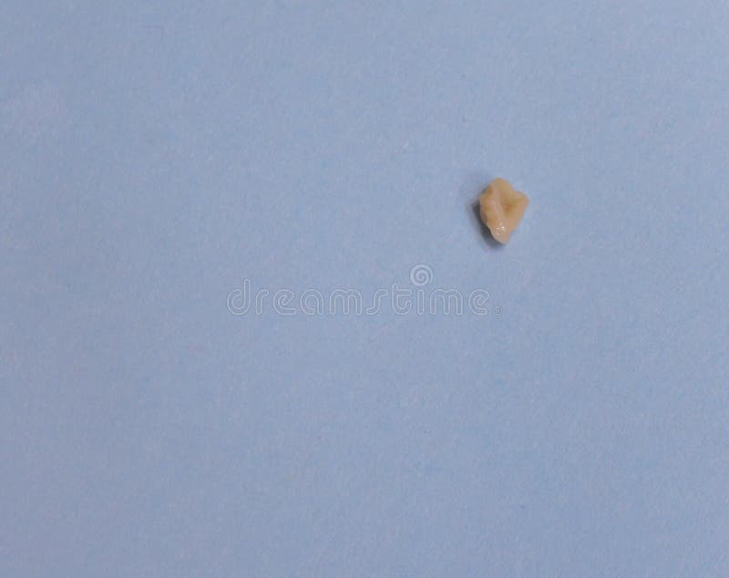 Tonsil stone tonsillolith stock photo. Image of immune - 187679774