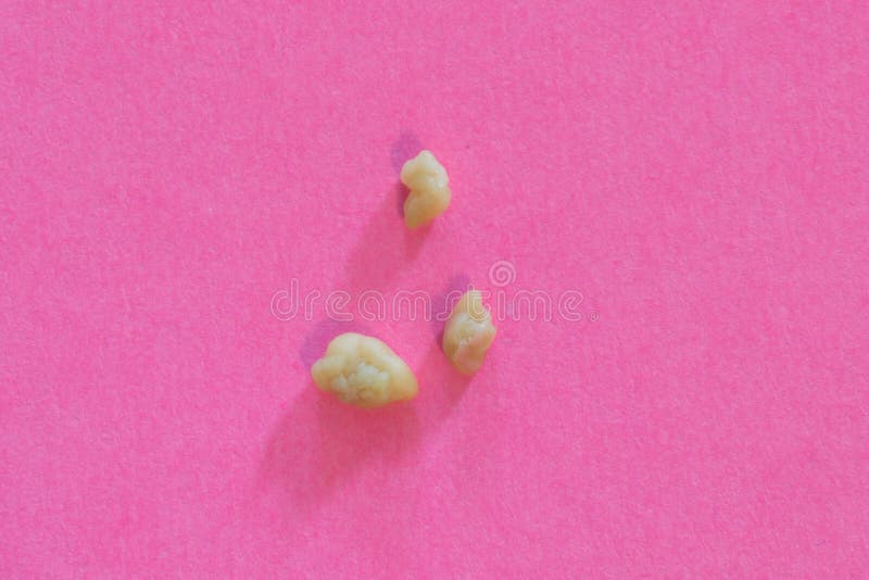 Tonsil stone tonsillolith stock image. Image of halitosis - 189600125