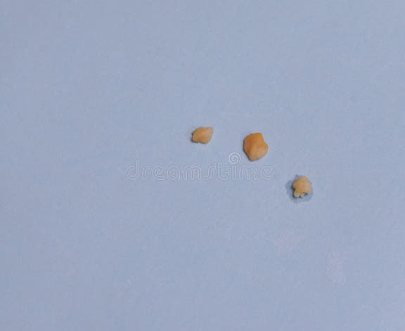 Tonsil stone tonsillolith stock photo. Image of calculi - 187679742