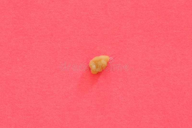 Tonsil stone tonsillolith stock image. Image of breath - 189600117