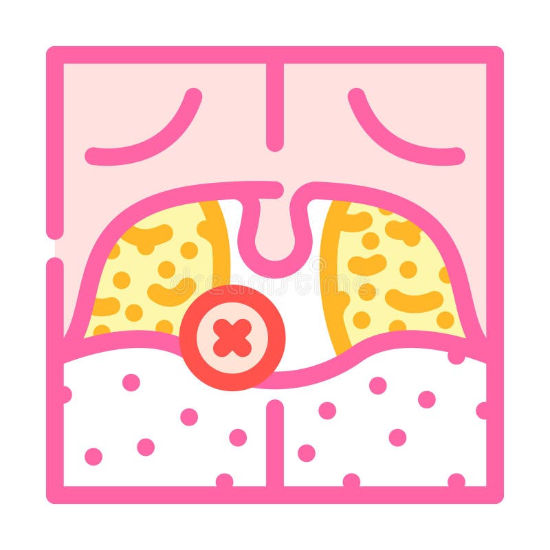 Tonsillectomy Surgery Color Icon Vector Illustration Stock Illustration ...