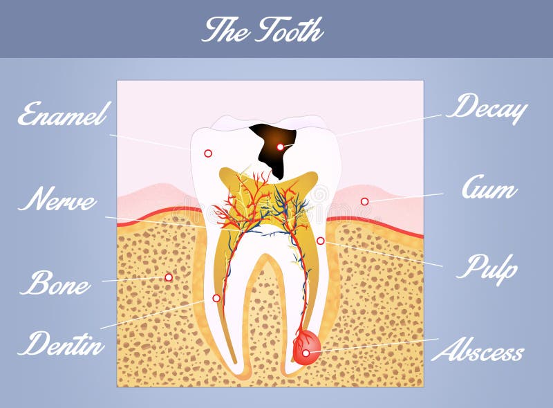 The tooth decay stock illustration. Illustration of scheme - 58167232