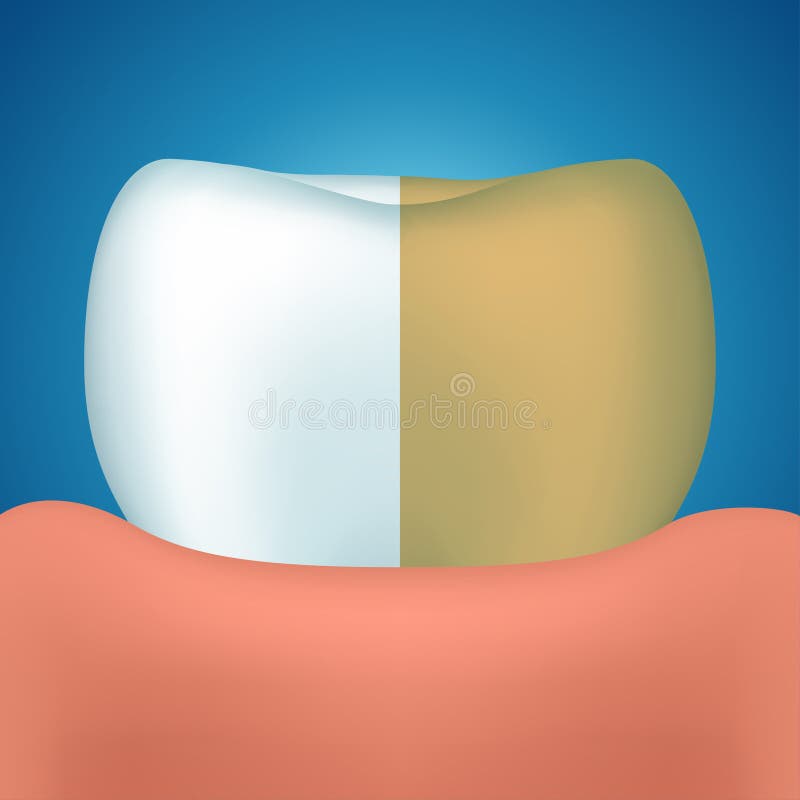 Tooth on blue stock vector. Illustration of healthcare - 87817960