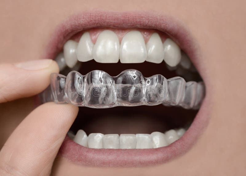 Tooth Braces Aligner Retainer Teeth Bite Rack Stock Photo - Image of ...