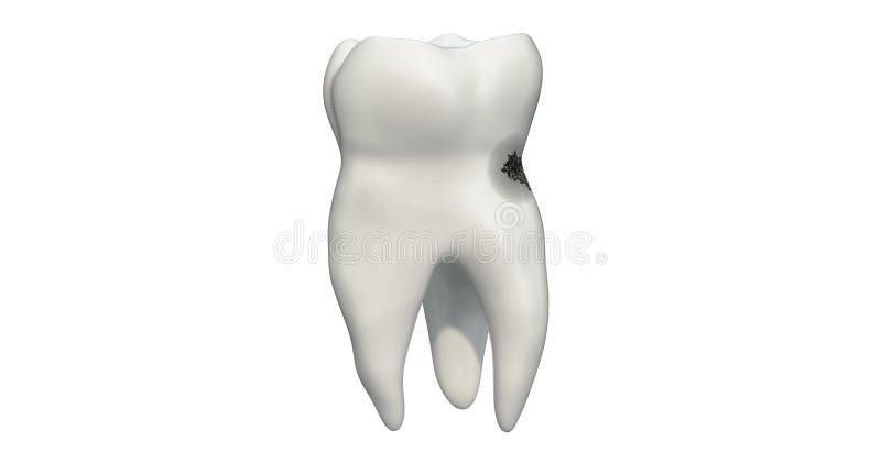 Stages of Tooth Decay or Dental Caries Stock Footage - Video of flat ...