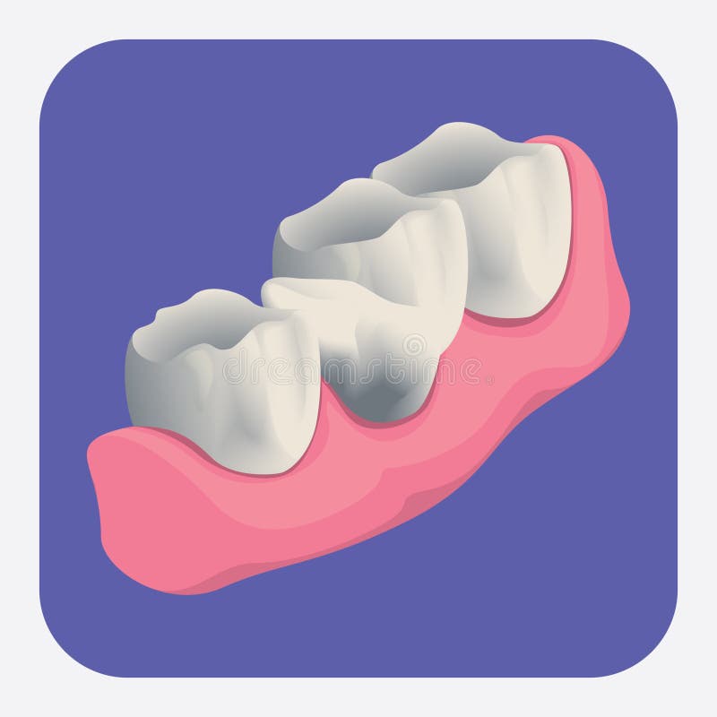 Tooth with Cavity. Vector Illustration Decorative Design Stock Vector ...