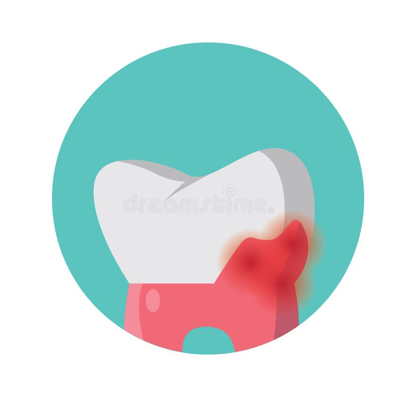 Tooth with Cavity. Vector Illustration Decorative Design Stock Vector ...