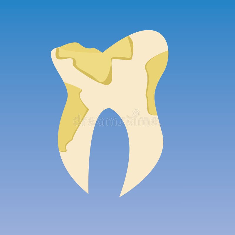Tooth with Cavity. Vector Illustration Decorative Design Stock Vector ...
