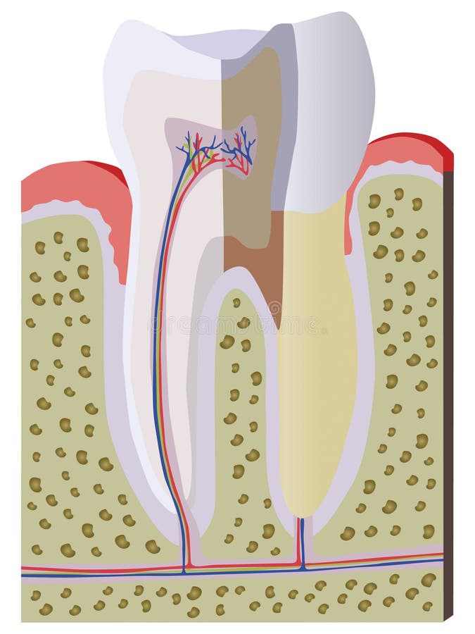 Caries stages stock vector. Illustration of denture, digestive - 19737411