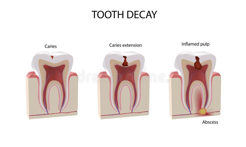 Tooth Damage Stages, Realistic Illustration, Dental Stock Vector ...