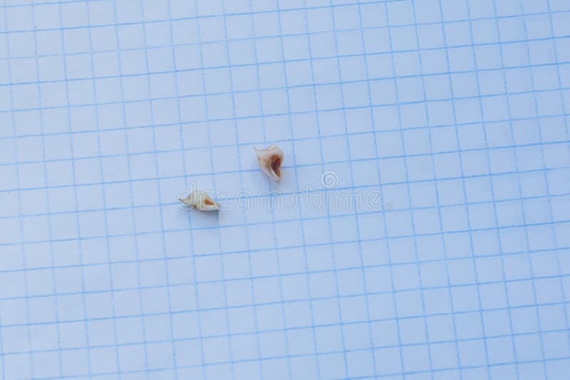 Tooth Decay. Badly Decayed Extracted Teeth Stock Photo - Image of macro ...