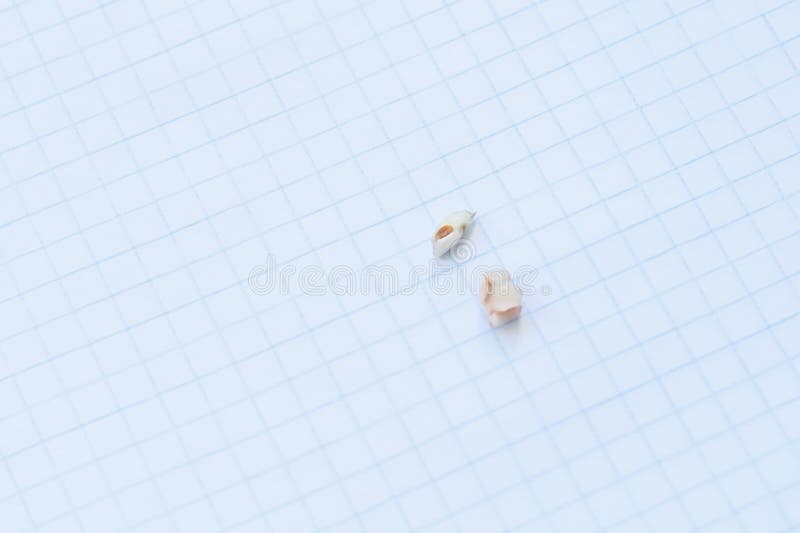 Tooth Decay. Badly Decayed Extracted Teeth Stock Photo - Image of ...