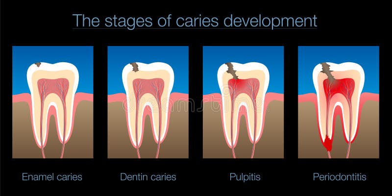 Stages Caries Development Stock Illustrations – 53 Stages Caries ...