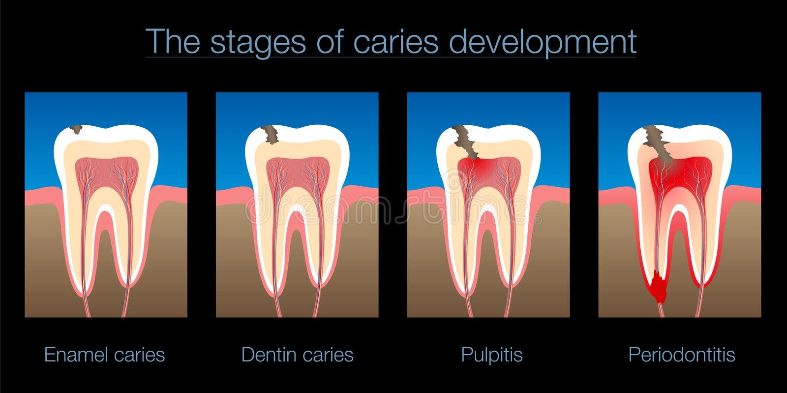 Tooth Cross Section Dental Caries Stock Illustrations – 168 Tooth Cross ...
