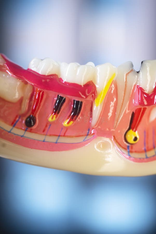 Tooth decay dental model stock image. Image of human - 214828417
