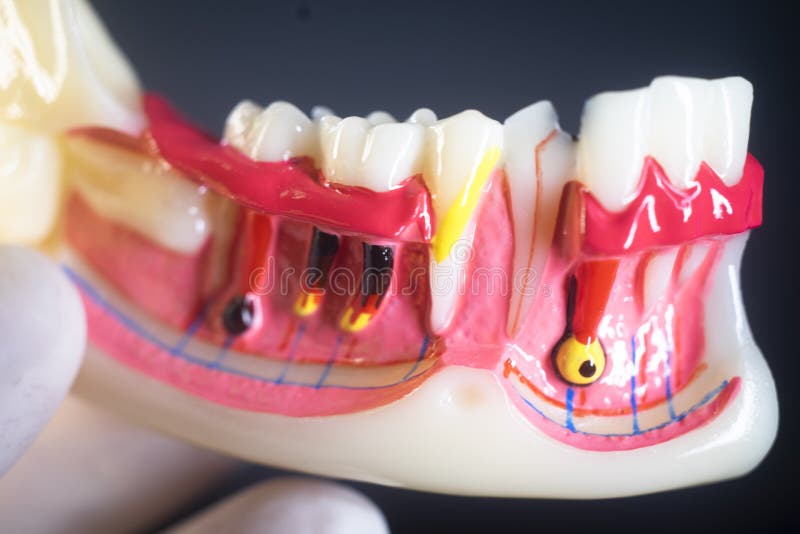 Tooth decay dental model stock photo. Image of health - 214828422
