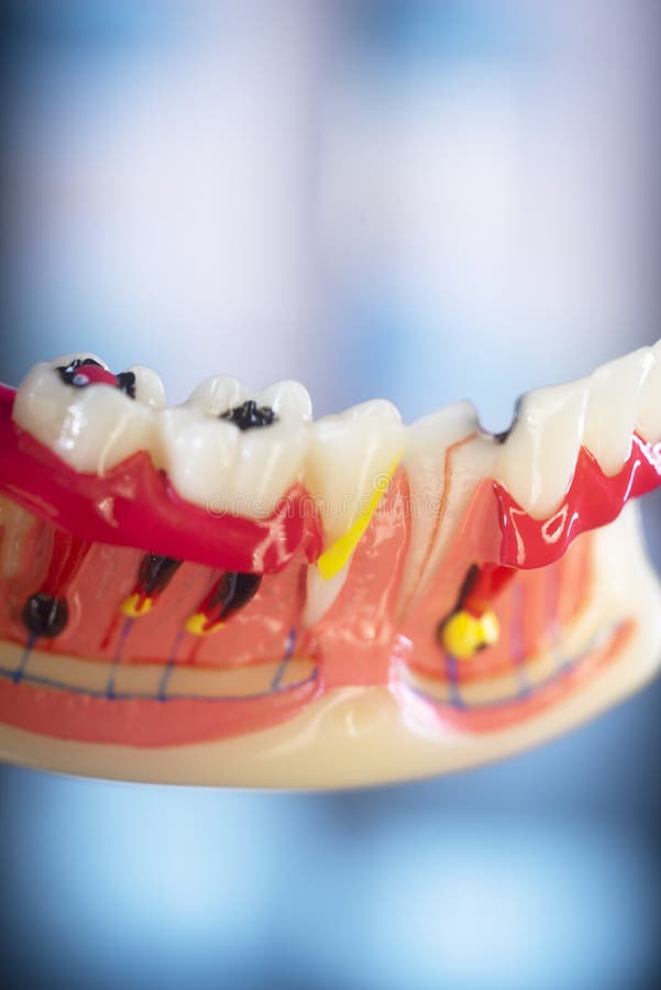 Tooth decay dental model stock photo. Image of human - 215490990