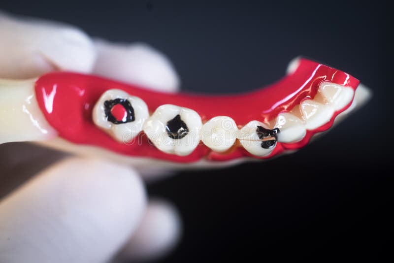 Tooth decay dental model stock image. Image of health - 227923221