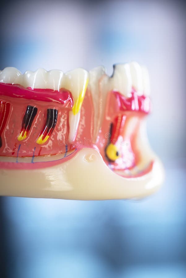Tooth decay dental model stock photo. Image of orthodontist - 230985490