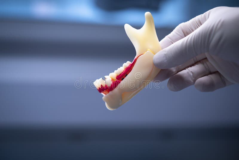 Tooth decay dental model stock photo. Image of cavity - 203131454