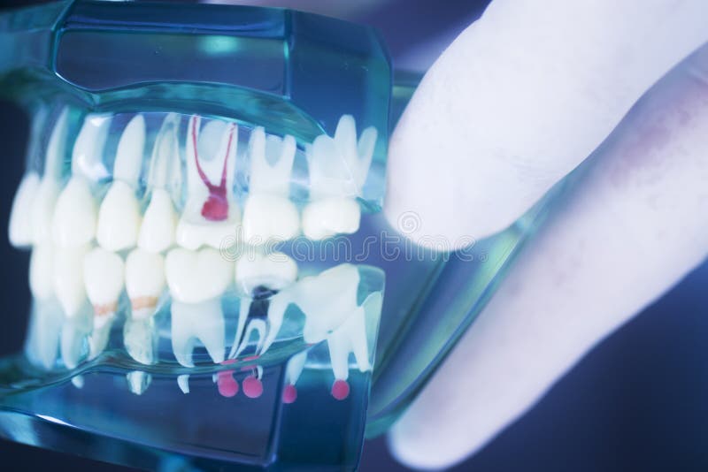 Tooth decay dental model stock image. Image of dentistry - 234699765