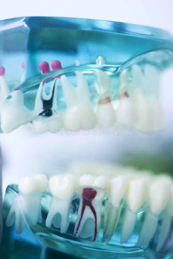 Tooth decay dental model stock image. Image of implantation - 203131439