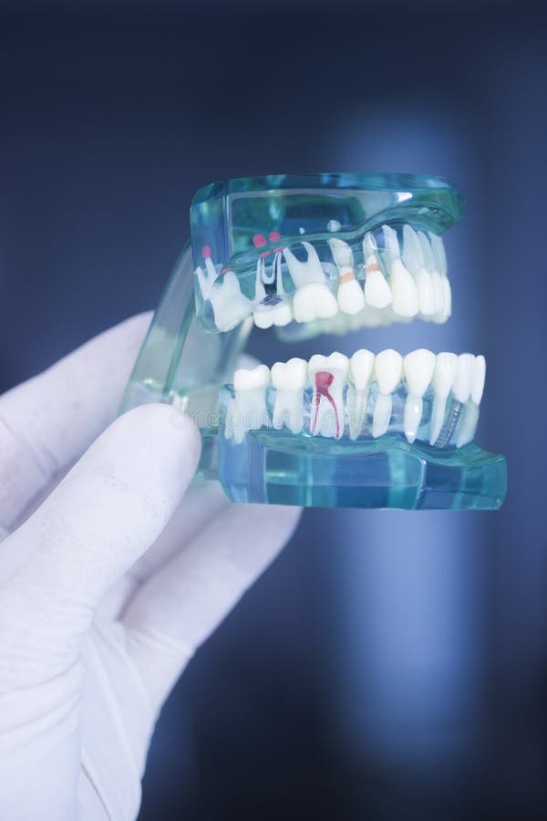 Tooth decay dental model stock photo. Image of orthodontist - 214828624