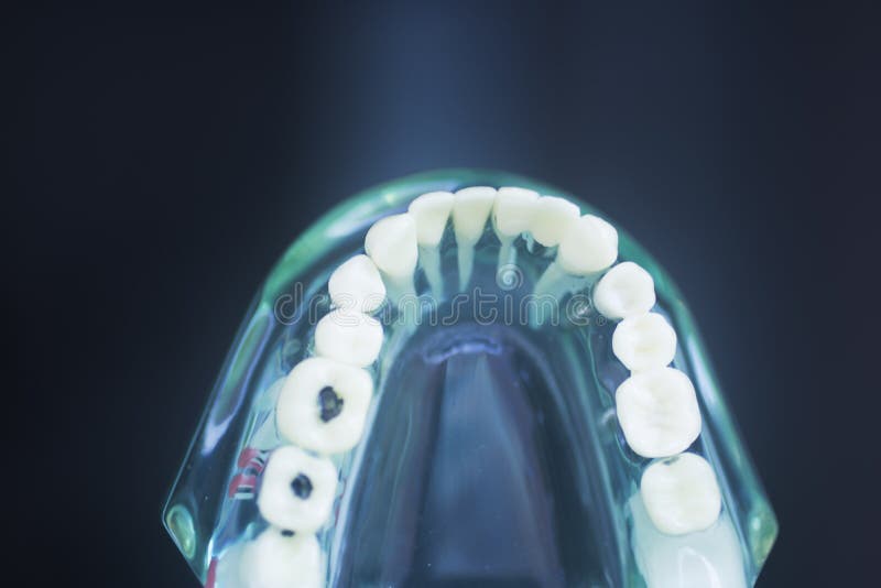 Tooth decay dental model stock photo. Image of cavity - 230985598