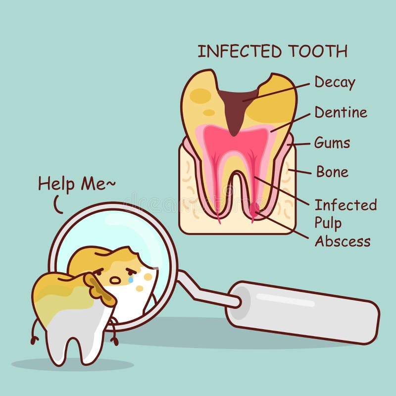Tooth Decay with Health Problem Stock Vector - Illustration of enamel ...