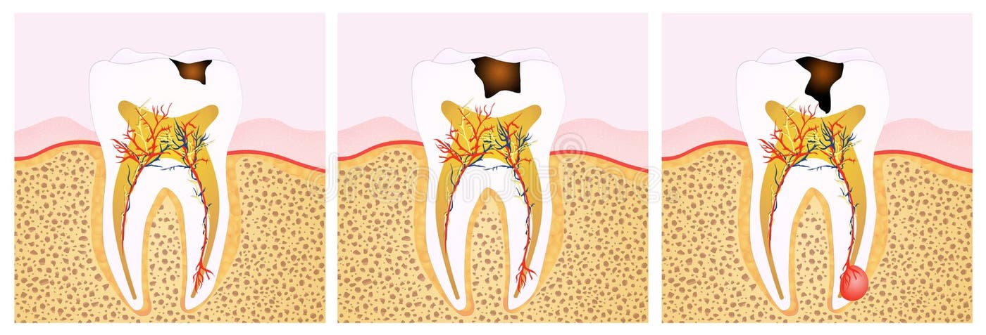 Tooth Decay Illustration Stock Illustrations – 8,010 Tooth Decay ...