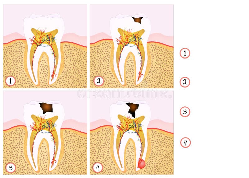 Tooth decay scheme stock illustration. Illustration of enamel - 71386164
