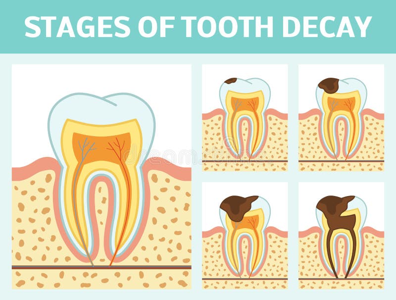 Tooth decay stages stock illustration. Illustration of disease - 82408196