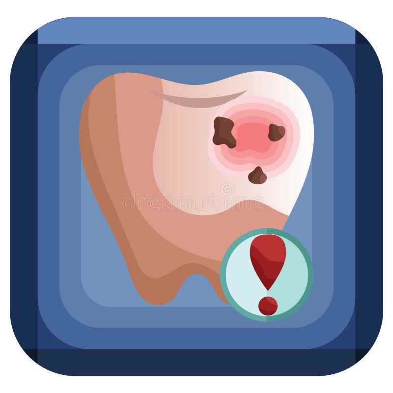 Tooth Decay. Vector Illustration Decorative Design Stock Vector ...